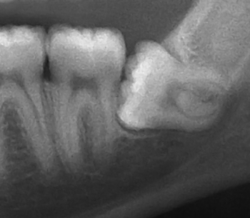 Horizontal_impacted_wisdom_tooth - GlobalDentalPro